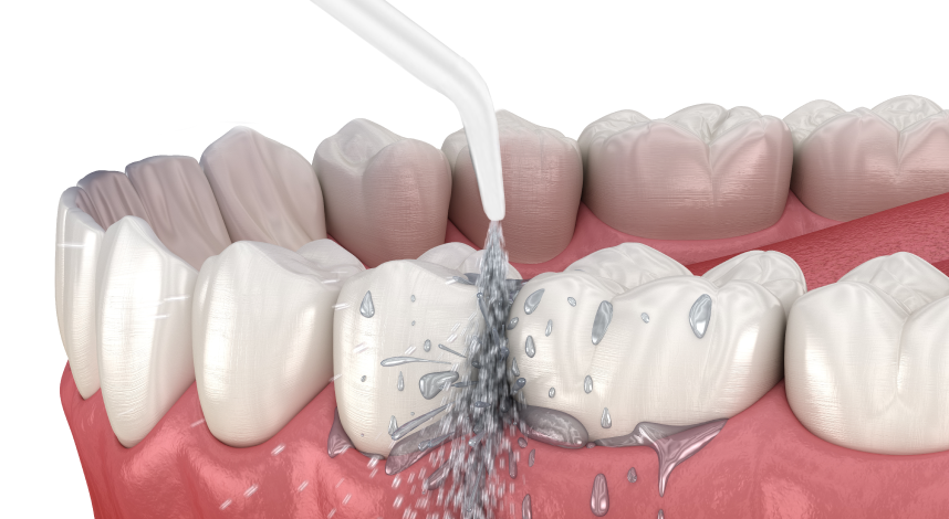 Waterpulse Tooth Cleaner
